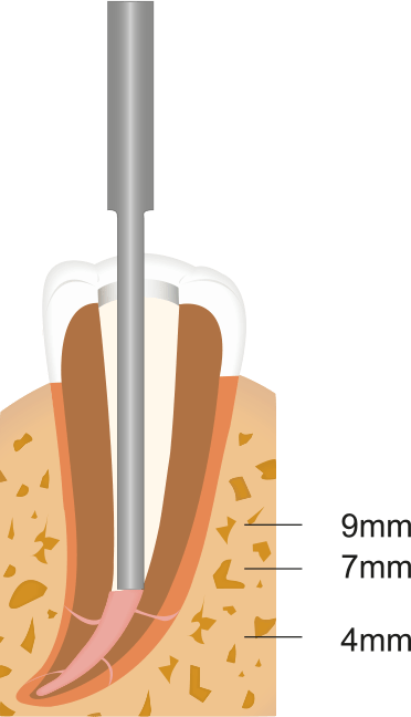 Urządzenia - Gutaperki, sączki, kompozyty, wypełnienia, endodoncja ...